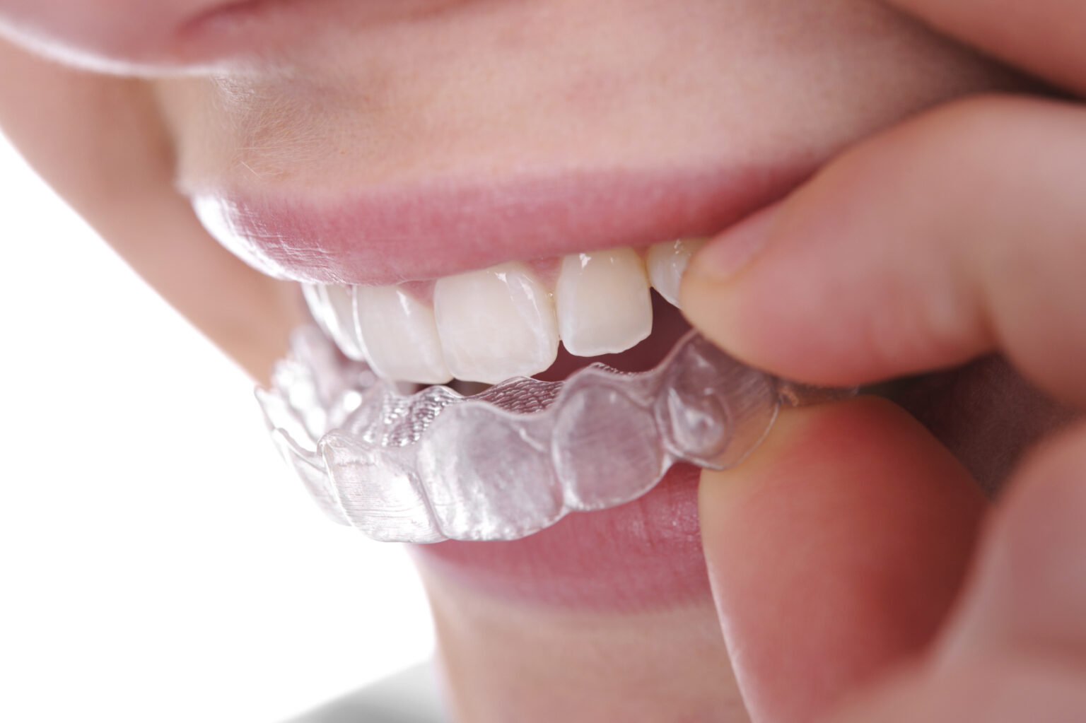 Invisalign Orthodontist Niagara Falls and St Catharines